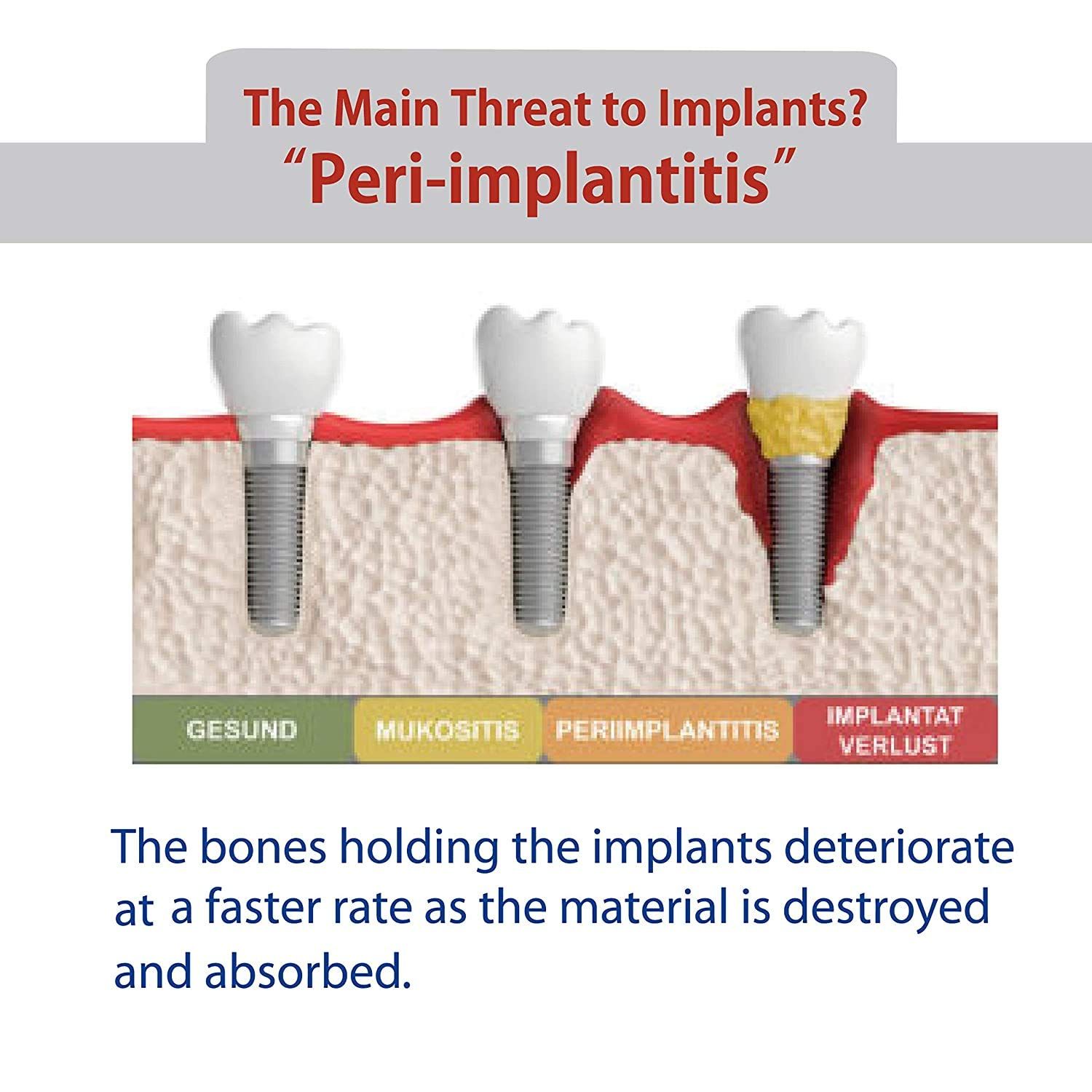 Buy Impla-n Toothpaste For Oral Care, Implants, Dentures, And Sensitive ...