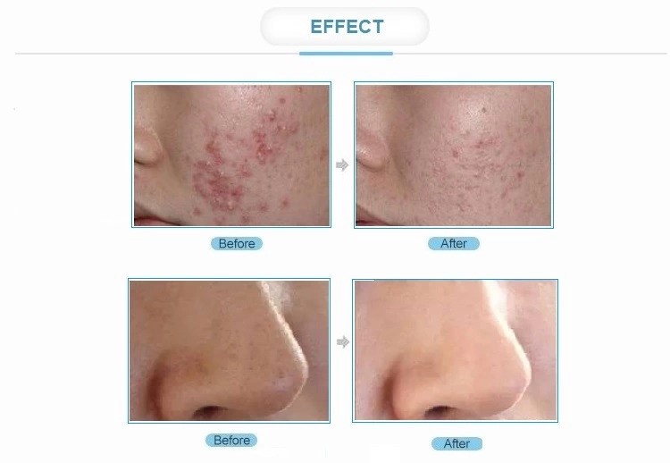 Buy Oxygen Water Jet Peel Machine Oxylight Facial from Guangzhou Huimei ...