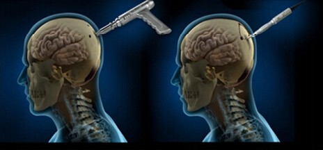 Buy Single-use Craniotome Cutter Powered Surgical Tool Ce Marked from ...