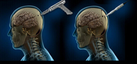 Buy Single-use Sterile Craniotome Cutter/cranial Cutting Blade/drill ...