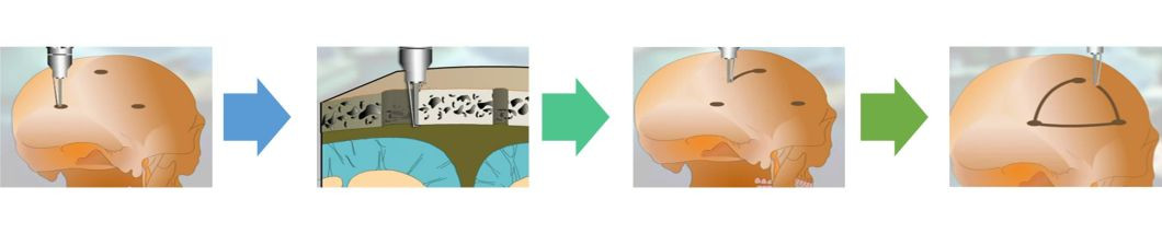 Buy Single-use Sterile Craniotome Cutter/cranial Cutting Blade/drill ...