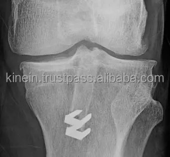 Buy Ligament Spike Staple Titanium Tendon Bone Fixation Kinein Acl ...