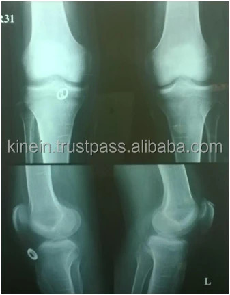 Buy Tibial Disc D Hole Round Hole Acl Pcl Graft Kinein Medtech Knee ...