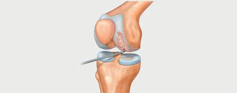 Buy Microfracture Awl Acl Pcl Tibia Femur Reconstruction Kinein Arthroscopy Knee Repair Surgical ...
