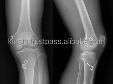 Buy Concave Attachable Loop Washer Button System With Collar Internal ...