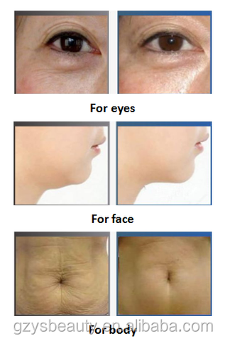 Buy Micropower Water Meso Nano Chips No Needle Mesotherapy Gun Facial ...