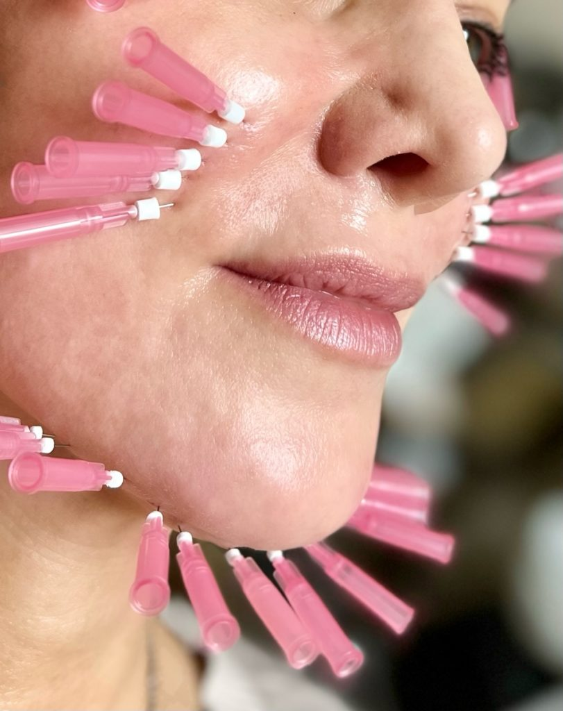 Buy Korean Pdo Pcl Plla Threads Mono Blunt W 30g13mm25mm For Under Eye ...