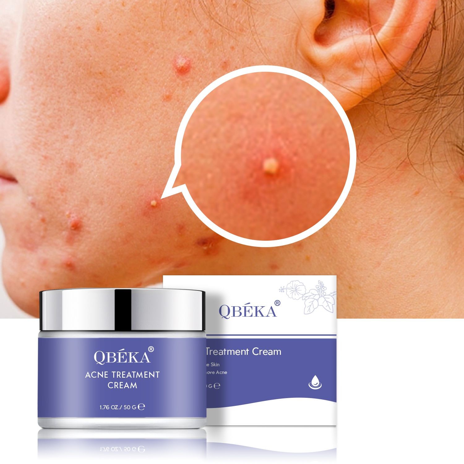Buy Oem Lighten Acne Marks Treatment Ceam Prmple Removal Vitamin E Tea ...