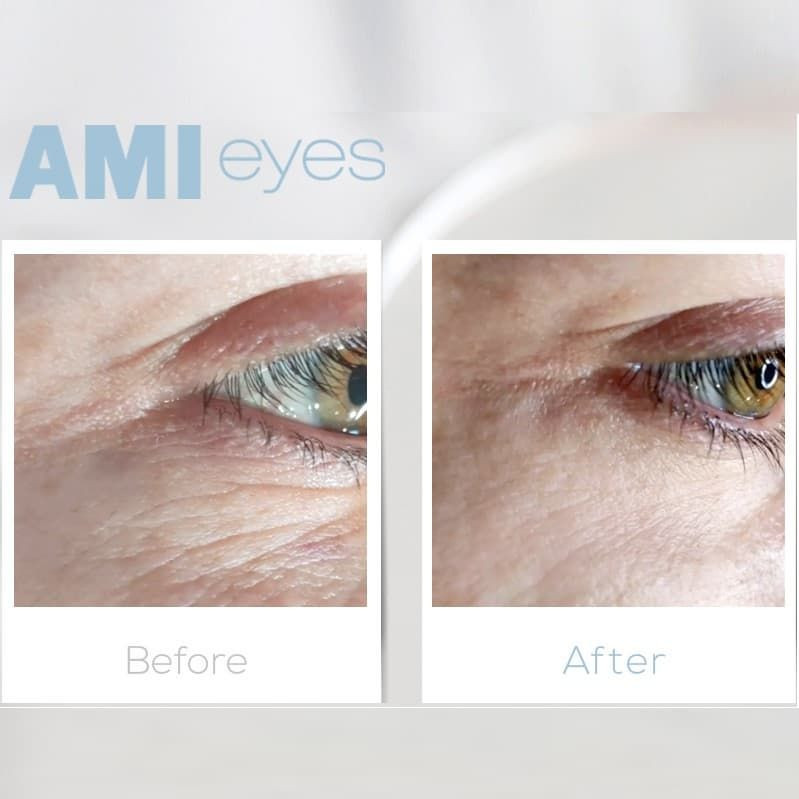 Buy Ami Eyes 1x2ml Pn Special Offer! from LINKUS GLOBAL CO., LTD ...