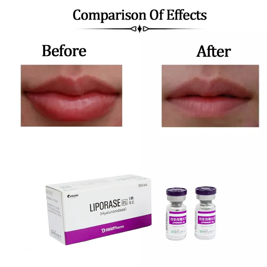 Buy Liporase Dissolve Hyaluronic Acid Hyaluronidase Liporase Injection ...