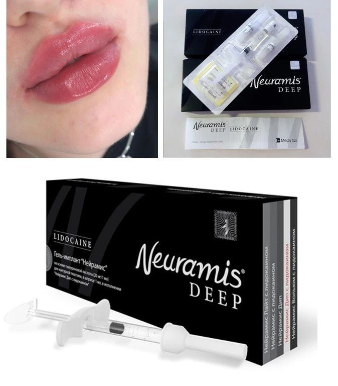 Buy Neuramis Hyaluronic Acid Dermal Filler For Cheeks Chin Forehead ...