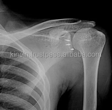 Buy Bankart Repair Suture Anchor Kinein Titanium Selfdrilling Preloaded ...