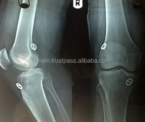 Buy Tibial Disc D Hole Round Hole Acl Pcl Graft Kinein Medtech Knee ...
