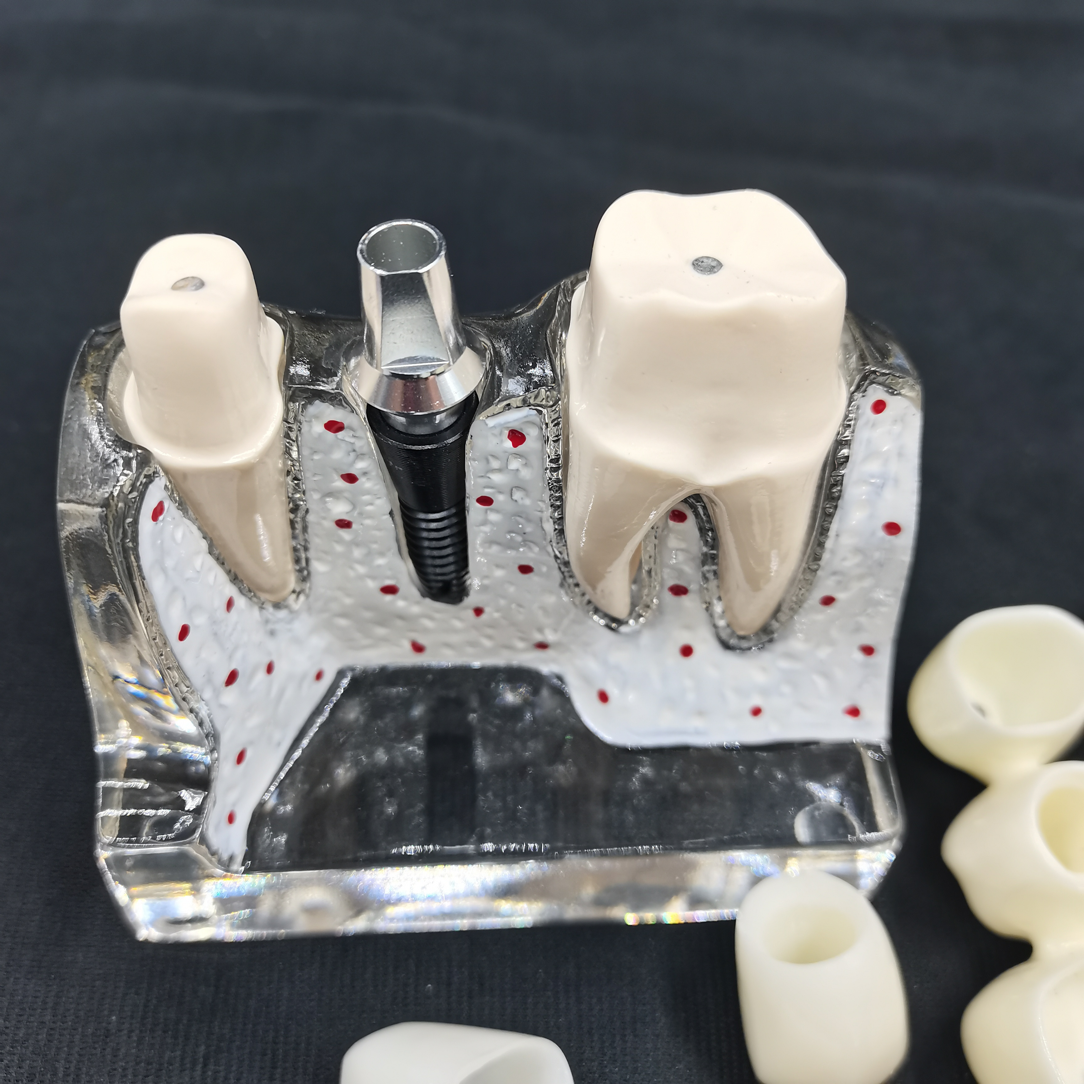Buy Dental Practice Transparent Implant Model Demo Overdenture ...