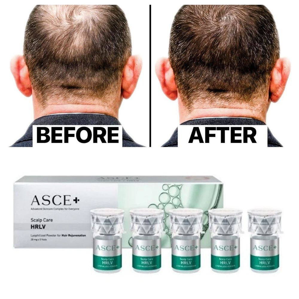 Buy Korean Asce Hrlv For Scalp Care And Anti Hair Loss Hair Booster ...