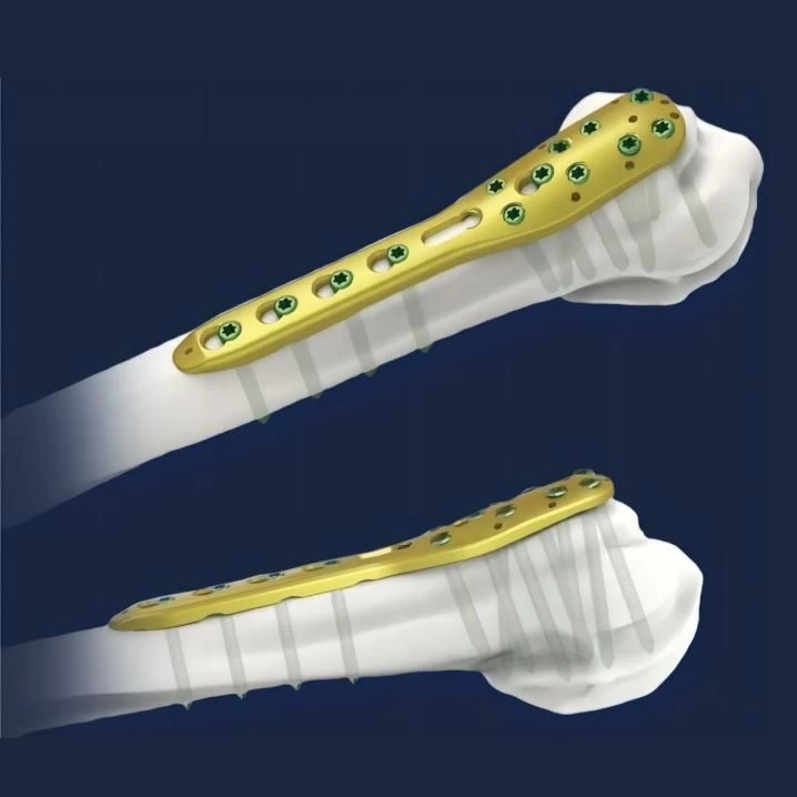 Buy Trauma Plates Iii from Ommedico Technology Co., Ltd, China ...