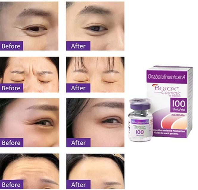 Buy Botox Cosmetic Botulinum Toxin Type A (onabotulinumtoxina) 100 ...