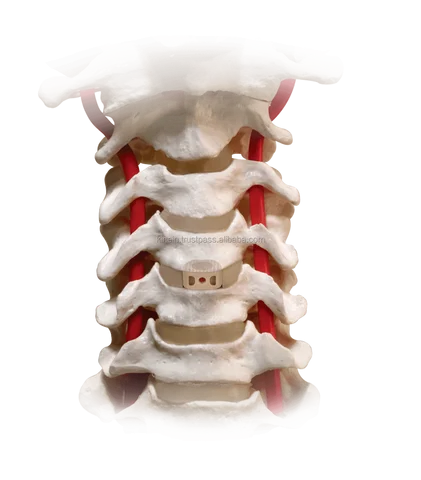 Buy Anterior Cervical Interbody Fusion Cage Device Spine Fixation ...