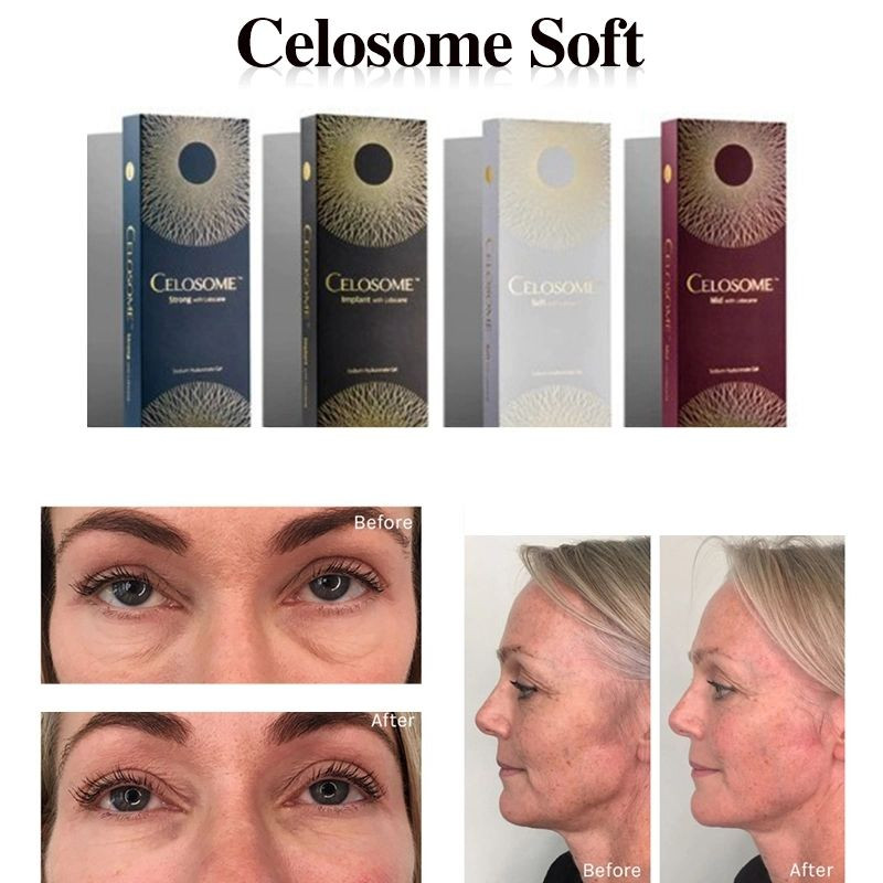 Buy Celosome 1.1ml Injectable Hyaluronic Acid Dermal Fillers 24mg/ml ...