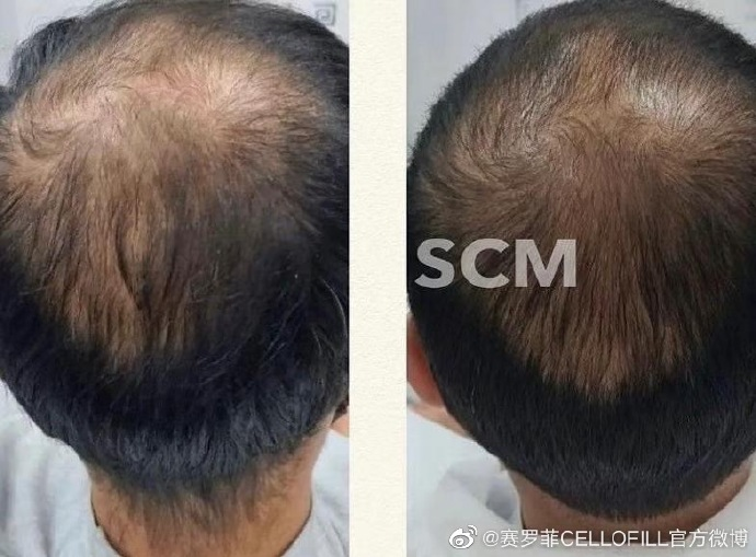Buy Scm Haircare Booster Hair Growth Products Stem Cell Growth Factors ...