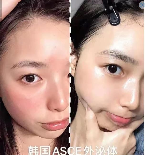 Buy Asce Exosomes Asce+ Srlv (20mg+5ml) Plus Derma Signal Pdrn Skin ...