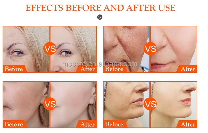 Buy Nabota Botulinum Toxin Type A – 100 Units from Tianjin Zhenmeichan ...