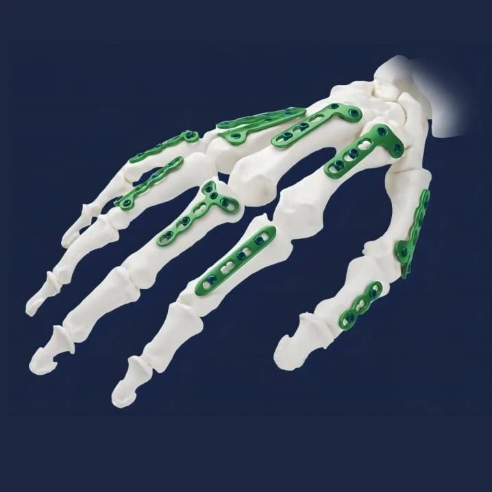 Buy Trauma Plates Ii from Ommedico Technology Co., Ltd, China ...