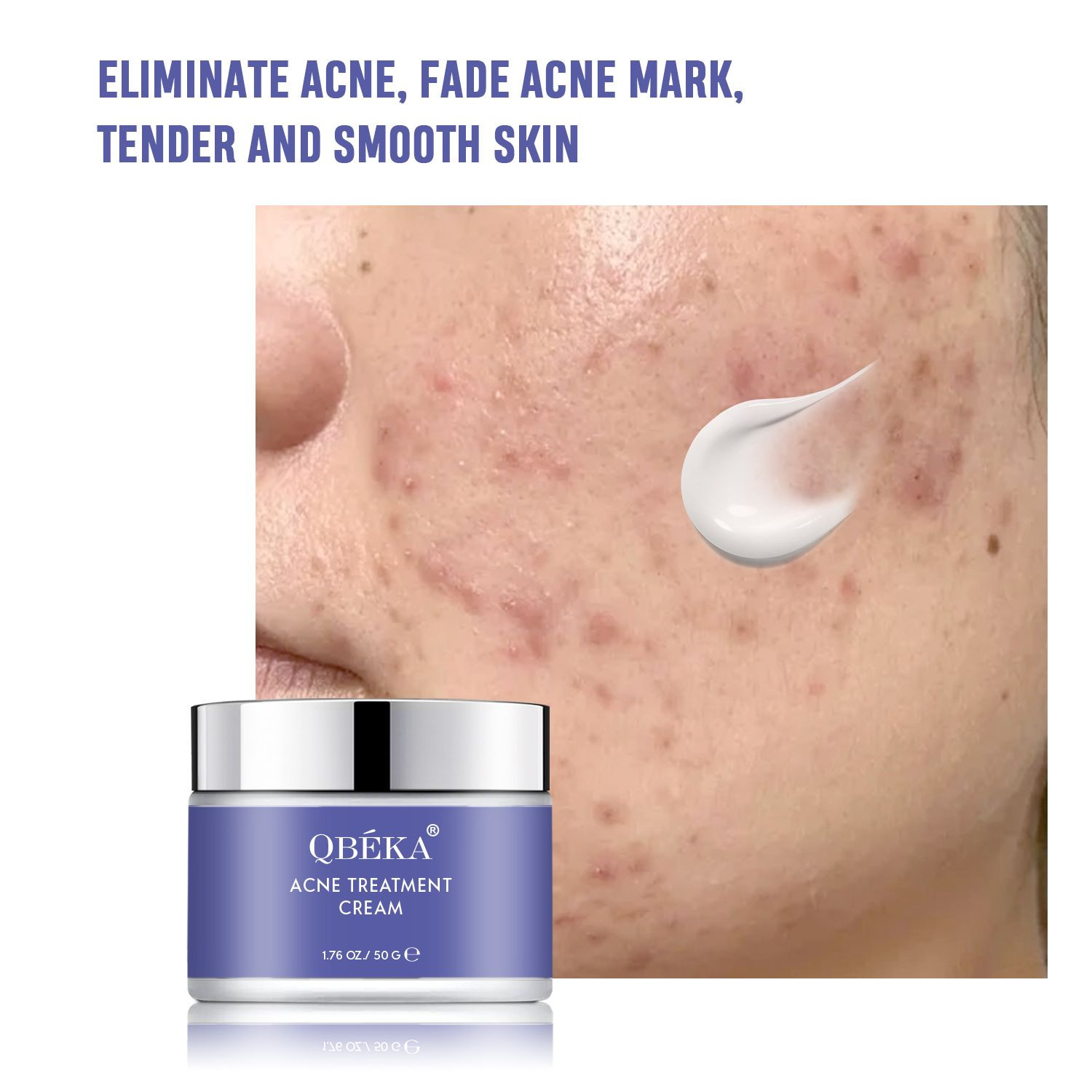 Buy Qbeka Lighten Acne Marks Treatment Ceam Prmple Removal Vitamin E ...