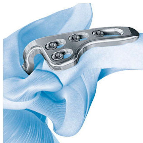 Buy Orthopedic Trauma Fracture Implant Clavicle Hook Clavicle Hook ...