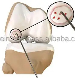 Buy Microfracture Awl Acl Pcl Tibia Femur Reconstruction Kinein Arthroscopy Knee Repair Surgical ...