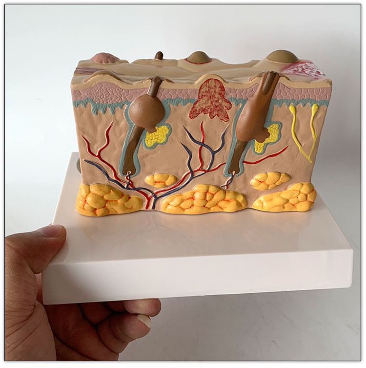 Buy Pathological Model Of Burned Skin Skin Anatomical Model Skin Model ...