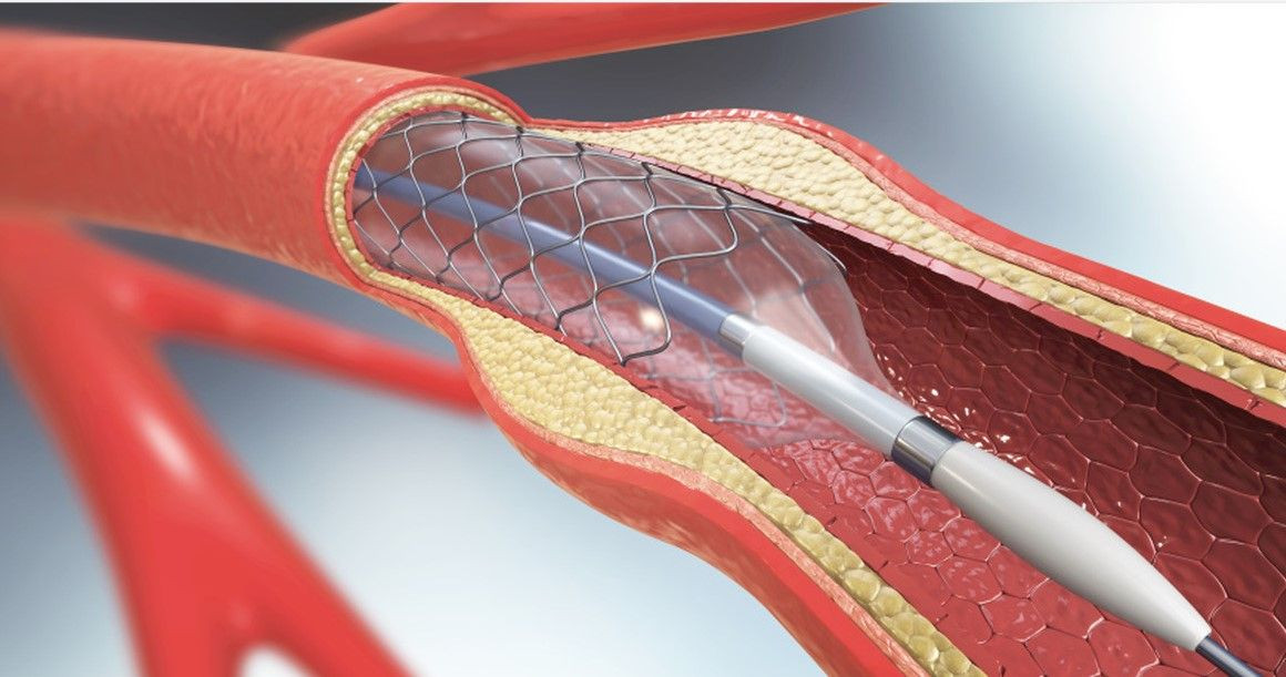 Buy Fully Bio-based Biodegradable Resorbable Cardiac Stent from ...