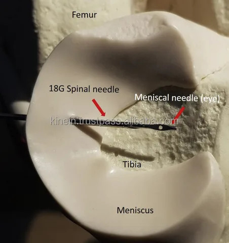 Buy Meniscus Repair Needle Inside Out Kinein Medtech Root Repair Knee ...